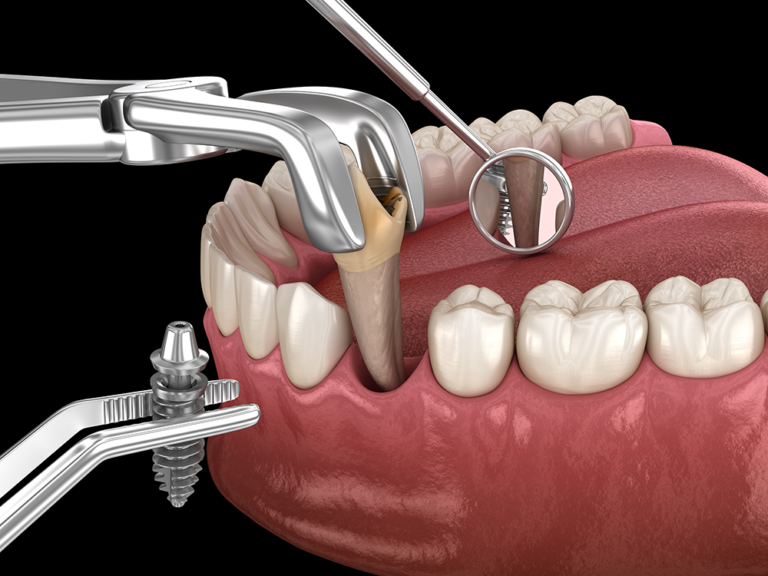Tooth Extraction – Align Dental Care